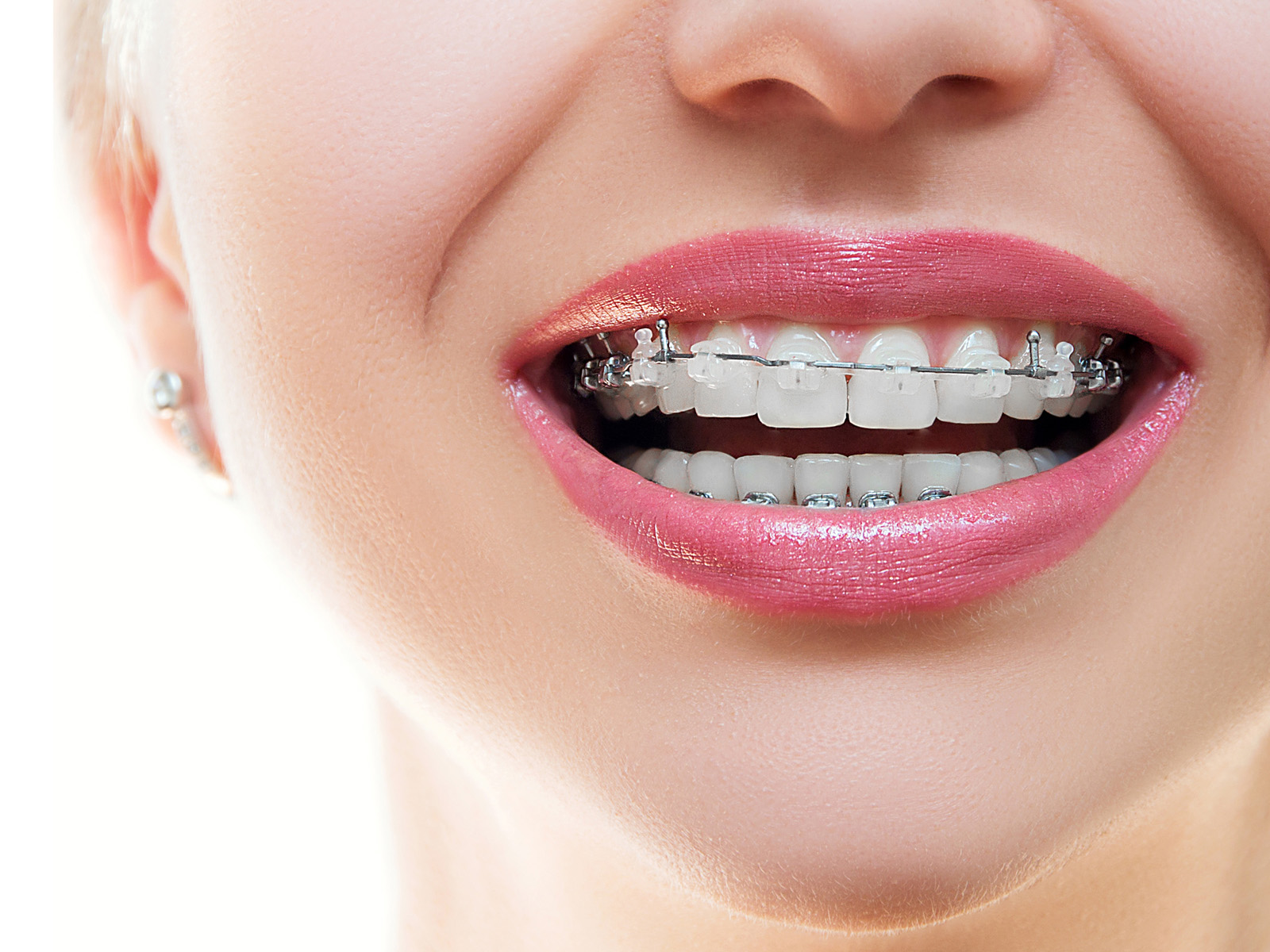How Long On Average Do Braces Stay On How Long On Average Do Braces Stay On