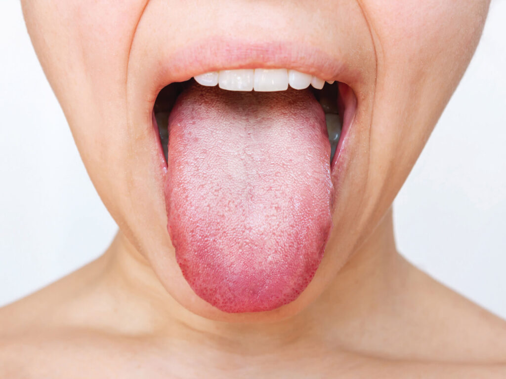 Tongue Health Indicators Why Is Tongue Health Vital