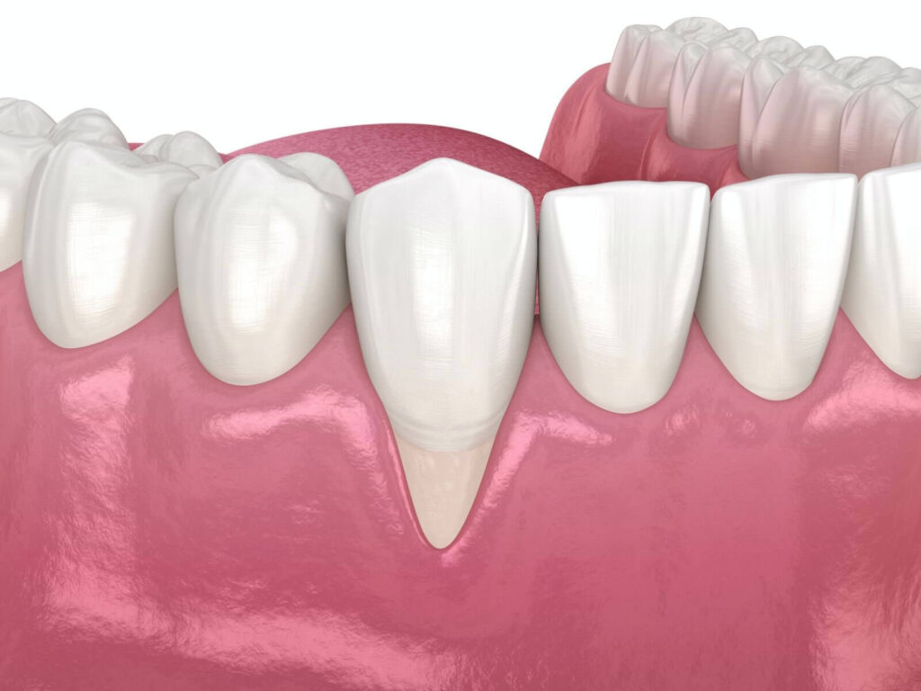 Why You Shouldn’t Ignore Early Signs of Gum Recession